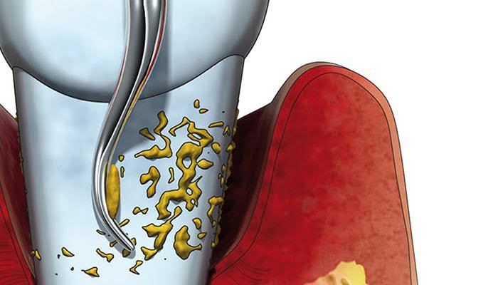 Ce este o pungă parodontală și cum se tratează?