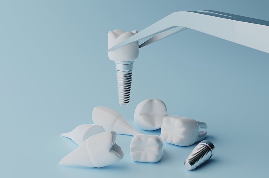 Pivot dentar sau implant? Care este diferența? - Omnia Dental