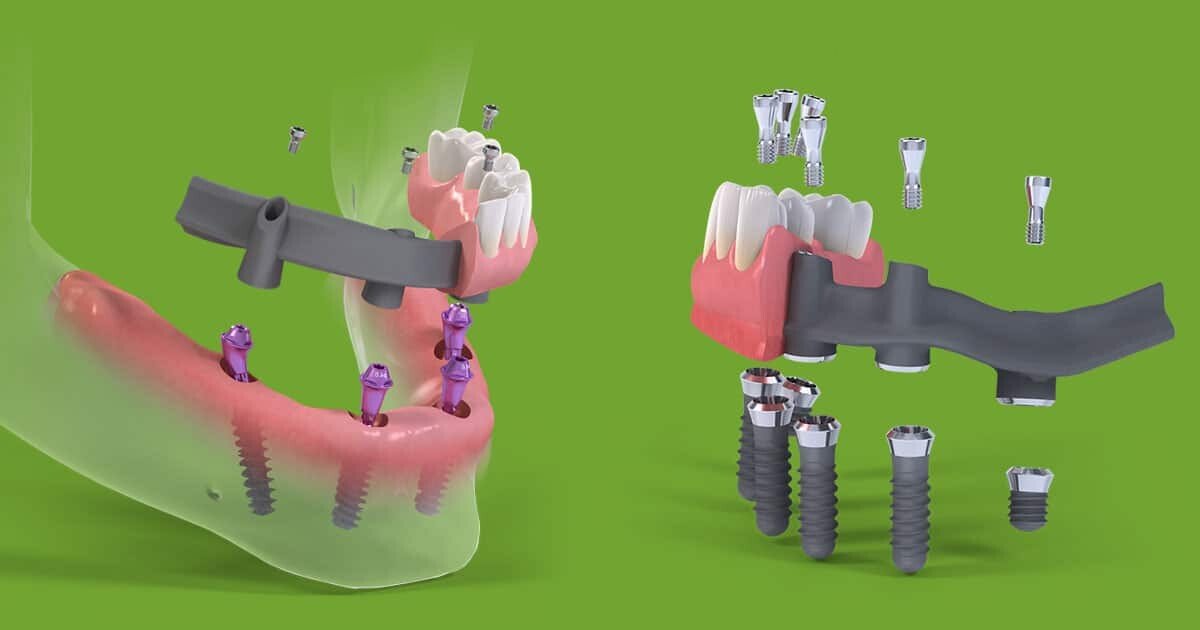 Sistemul Pro Arch de la Straumann: restaurare completă a danturii cu 4 ...